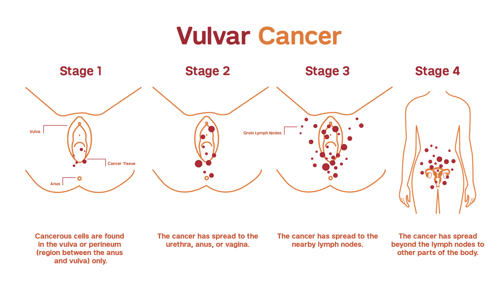 Vulvar Cancer Treatment & Diagnosis | Advanced Gynecologic Care